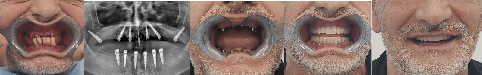 Dental Implants in Turkey – is cut-price worth it? – Sofia Implant Centre